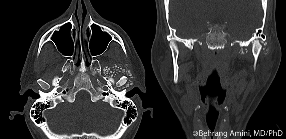 Roentgen Ray Reader: Synovial Chondromatosis of the Temporomandibular Joint