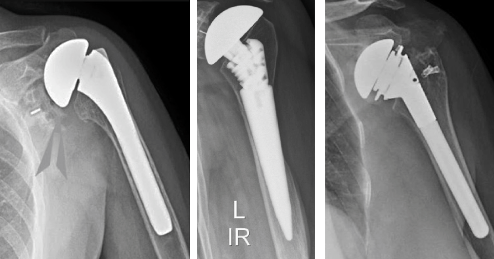 Shoulder Arthritis / Rotator Cuff Tears / Shoulder Pain : Shoulder ...