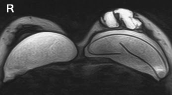 ABC Radiology Blog: MRI for Imaging Breast Implants