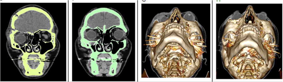 Enoftalmos post traumático