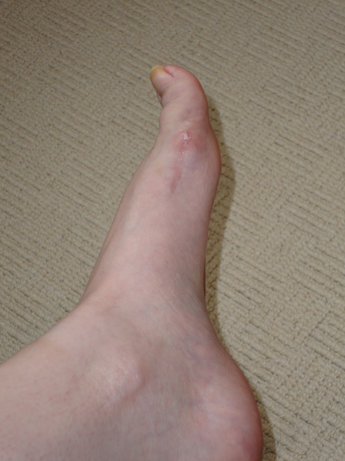 Gwen's Feet (and Hand): Weeks 18-24 Update!