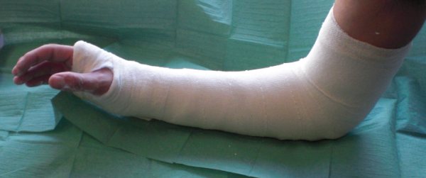 HOSPITAL DE MÓSTOLES: PRÁCTICAS EN URGENCIAS: Férulas