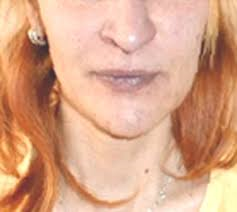 Cyanose// - Acute Zorg Blog