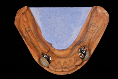 Boise Idaho Prosthodontics: Semi-Precision attachment RPD - 3 different ...