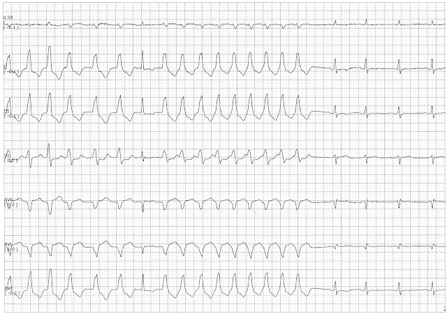 Ventricular Tachycardia Converting to Sinus Rhythm