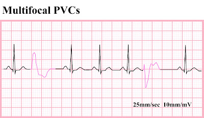 ECG Educator Blog : Ventricular Ectopics
