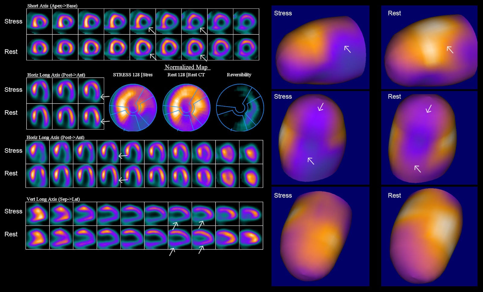 Tecnologia em Radiologia: Os Equipamentos de SPECT/CT