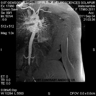 SPIN RADIOGRAPHERS: MRI POST CONTRAST ANGIO LEFT UPPERLIMB