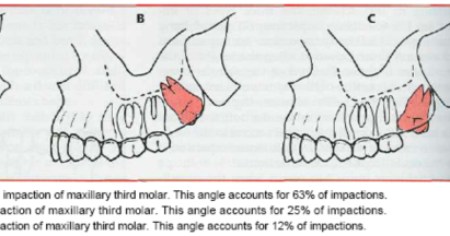 Kesehatan Gigi: Teknik Odontektomi Kedokteran Gigi, Pencabutan Molar 3 ...