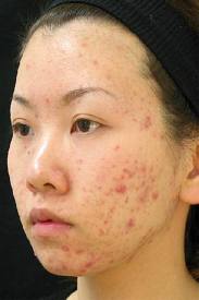 acne problems solution: Nodular Acne and how to resolve it!