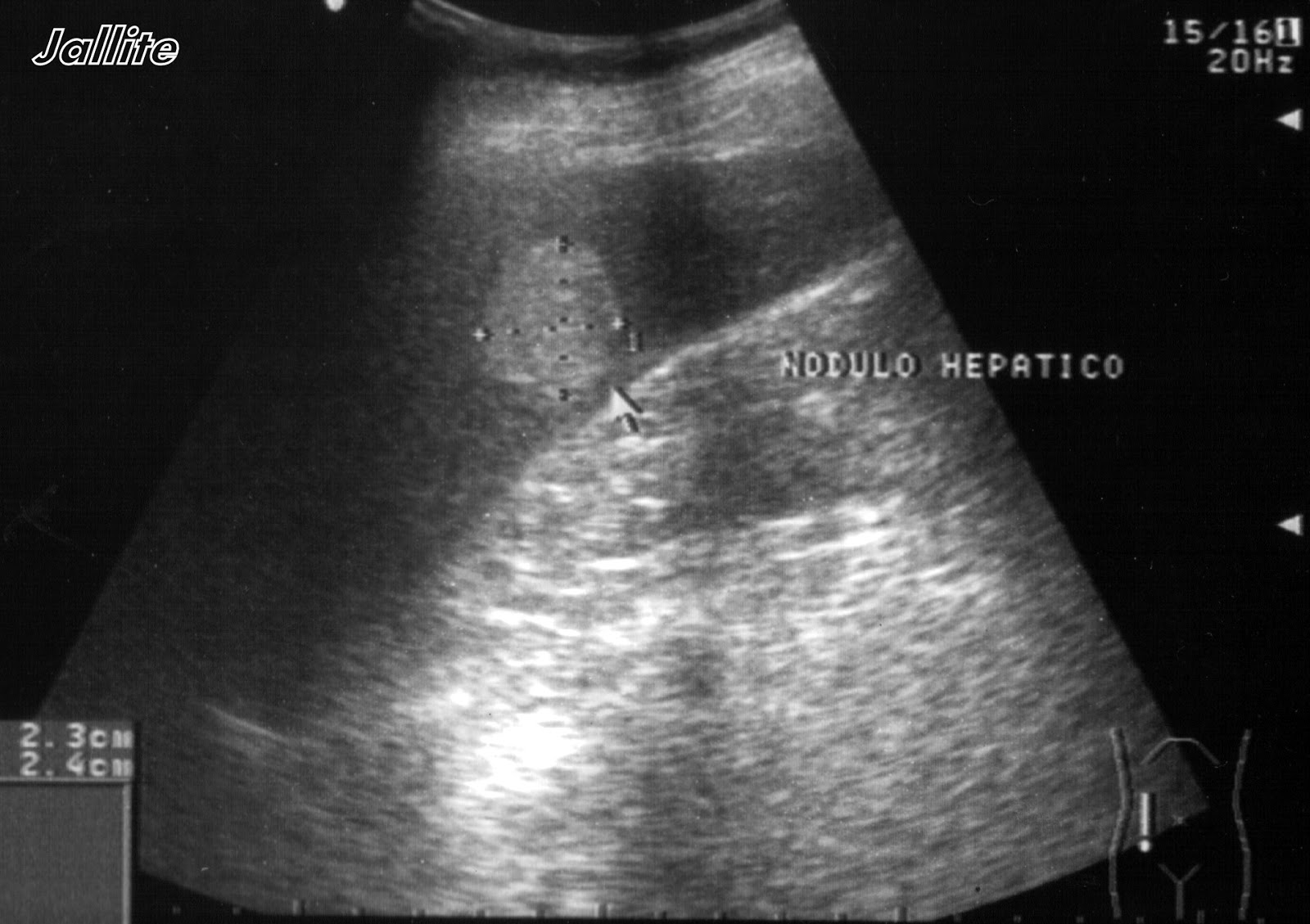 Nodulos Hepaticos y Lupus