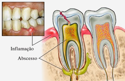 Clinica Dentaria Mais Sorriso: Sintomas e tratamento de abscessos ...