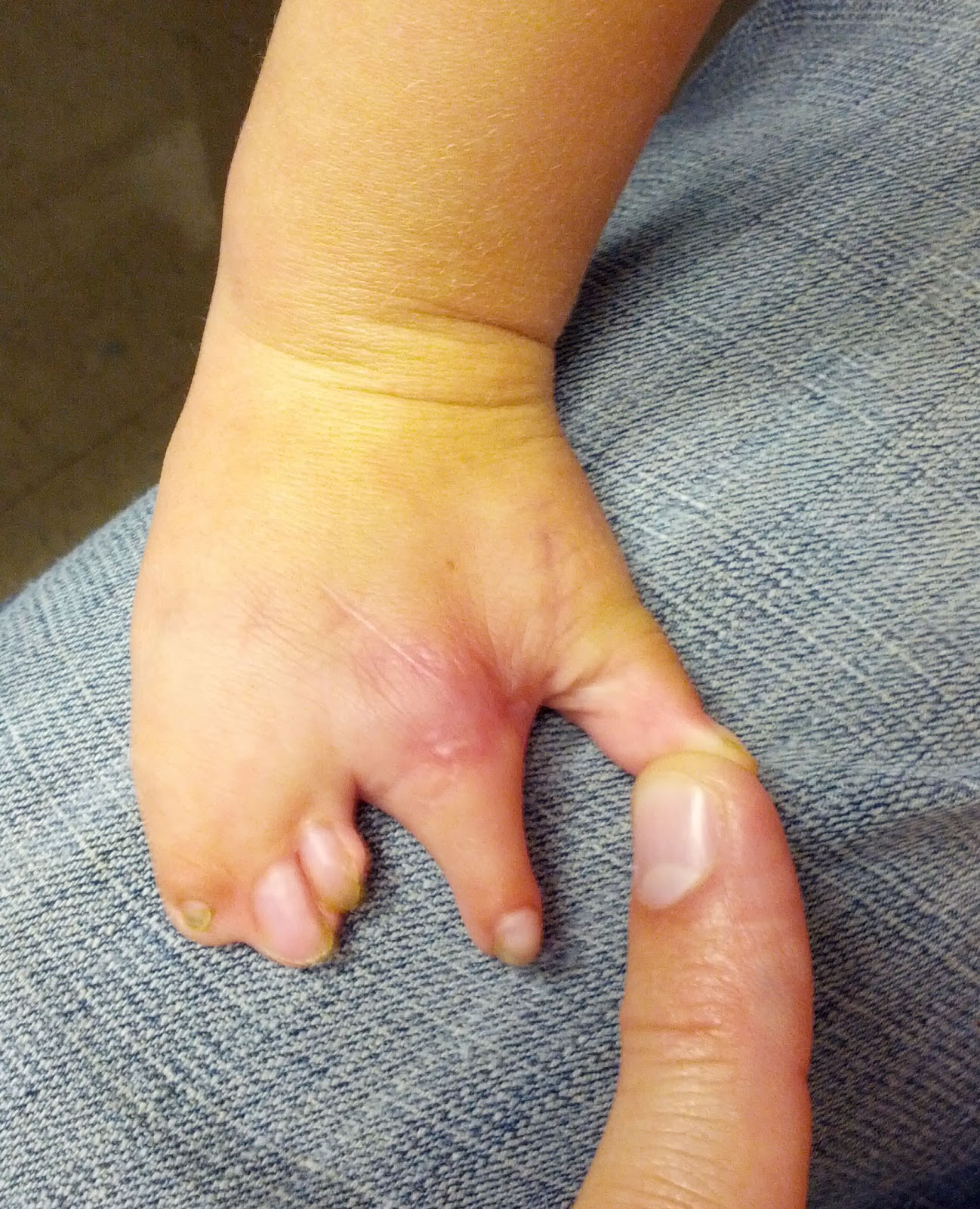 Webbing Between Fingers