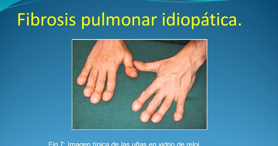 FIBROSIS PULMONAR IDIOPÁTICA