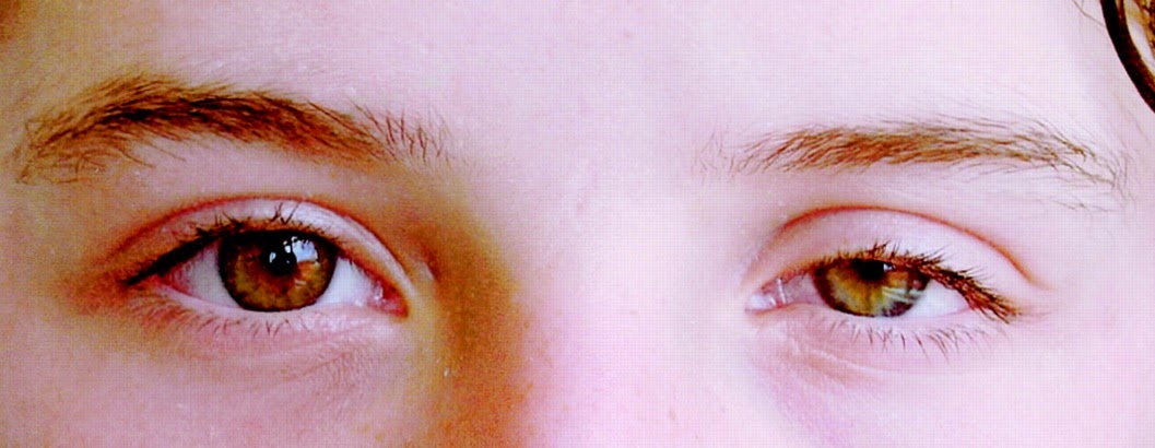 Doctors' Hub: Horner's Syndrome: Causes and Manifestations