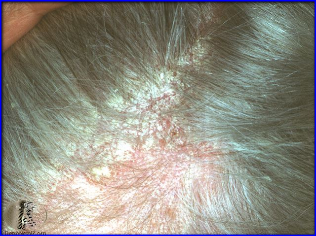 Seborrheic Dermatitis Pictures on Scalp, Face, and Infant’s Body and ...