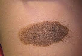 Jenis Harga Obat Tompel Yang Dijual Oleh Apotik Umum - SEDIA OBAT TOMPEL