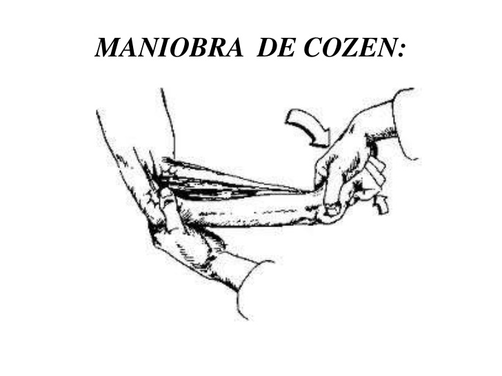 maniobra de cozen