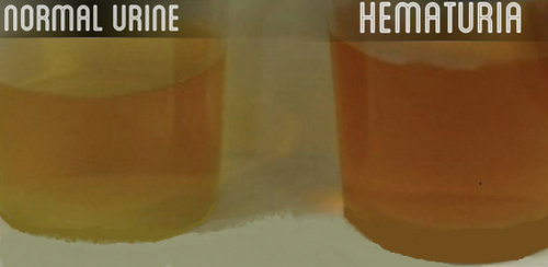 Mucus in Urine | eMedicalHelp