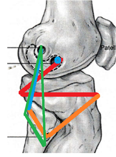 Joint Preservation and Replacement : Ligamentous injury to knee a ...