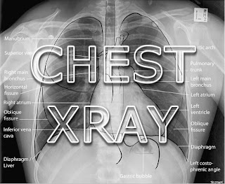 A Quick Guide to Chest X-Rays - IVLine