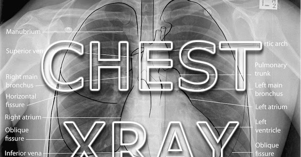 A Quick Guide to Chest X-Rays - IVLine