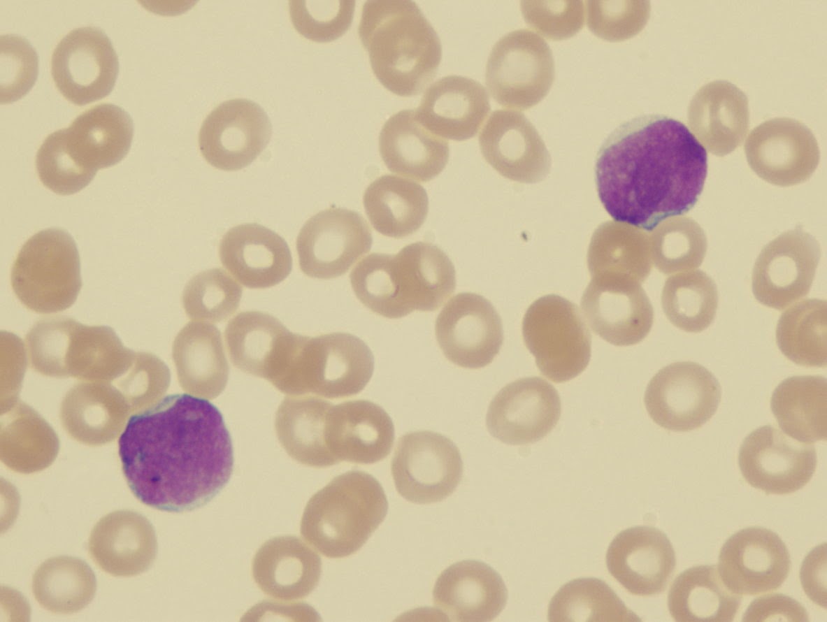 Medical Treatment Pictures-for Better Understanding: Leukemia - Acute ...