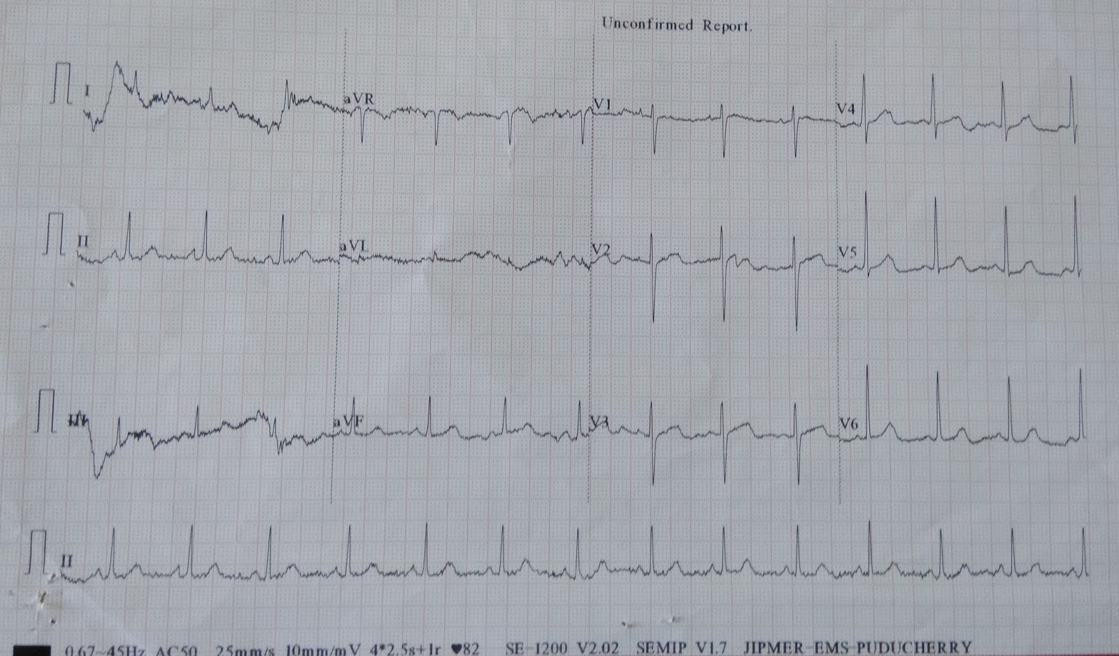 Cardiology window: SVT with aberrancy