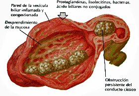 MEDICINA: COLECISTITIS AGUDA