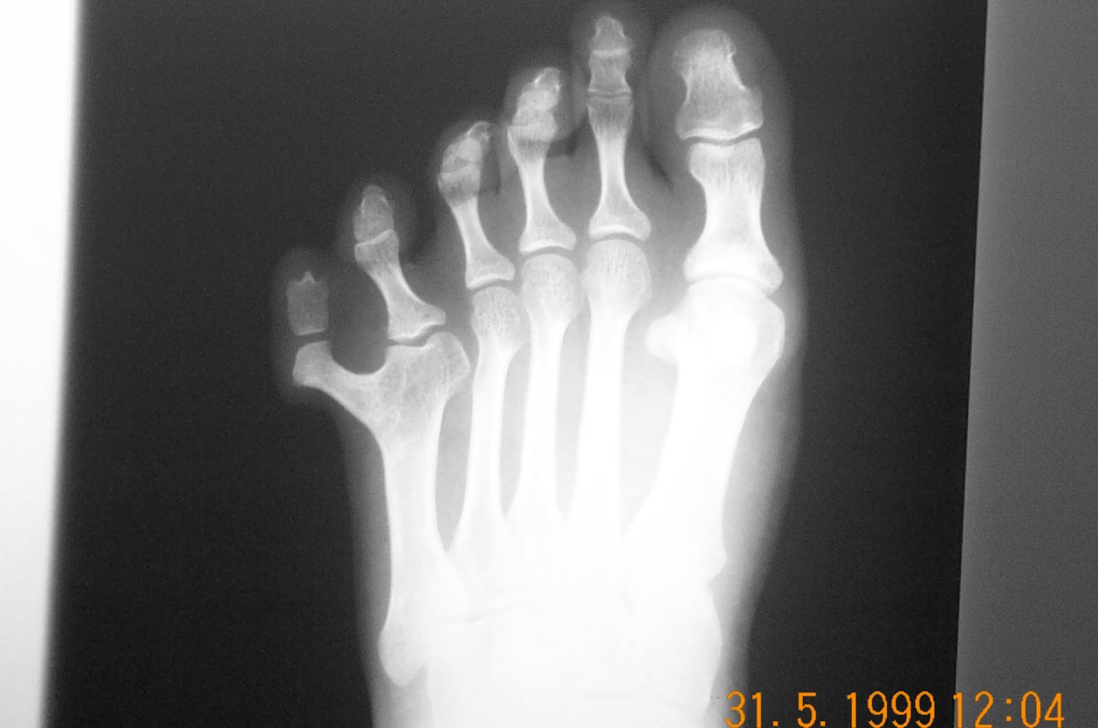 CIRUJANO DE PIE Y TOBILLO: POLIDACTILIA