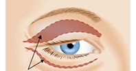 What is Eyelid Surgery