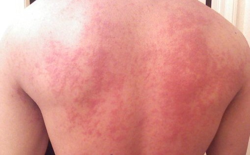 help autoimmune: Diagnosis of autoimmune urticaria