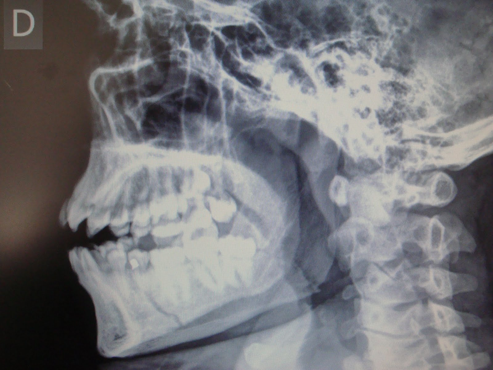 Fratura de Mandíbula por Arma de Fogo - CIRURGIA BUCOMAXILOFACIAL