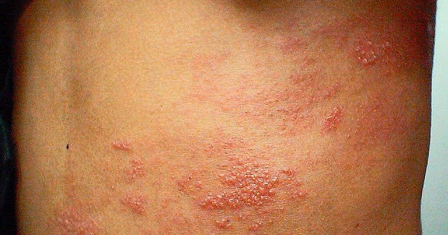 Apa itu penyakit kayap dan cara mencegahnya dengan vivix... ~ CINTA ...