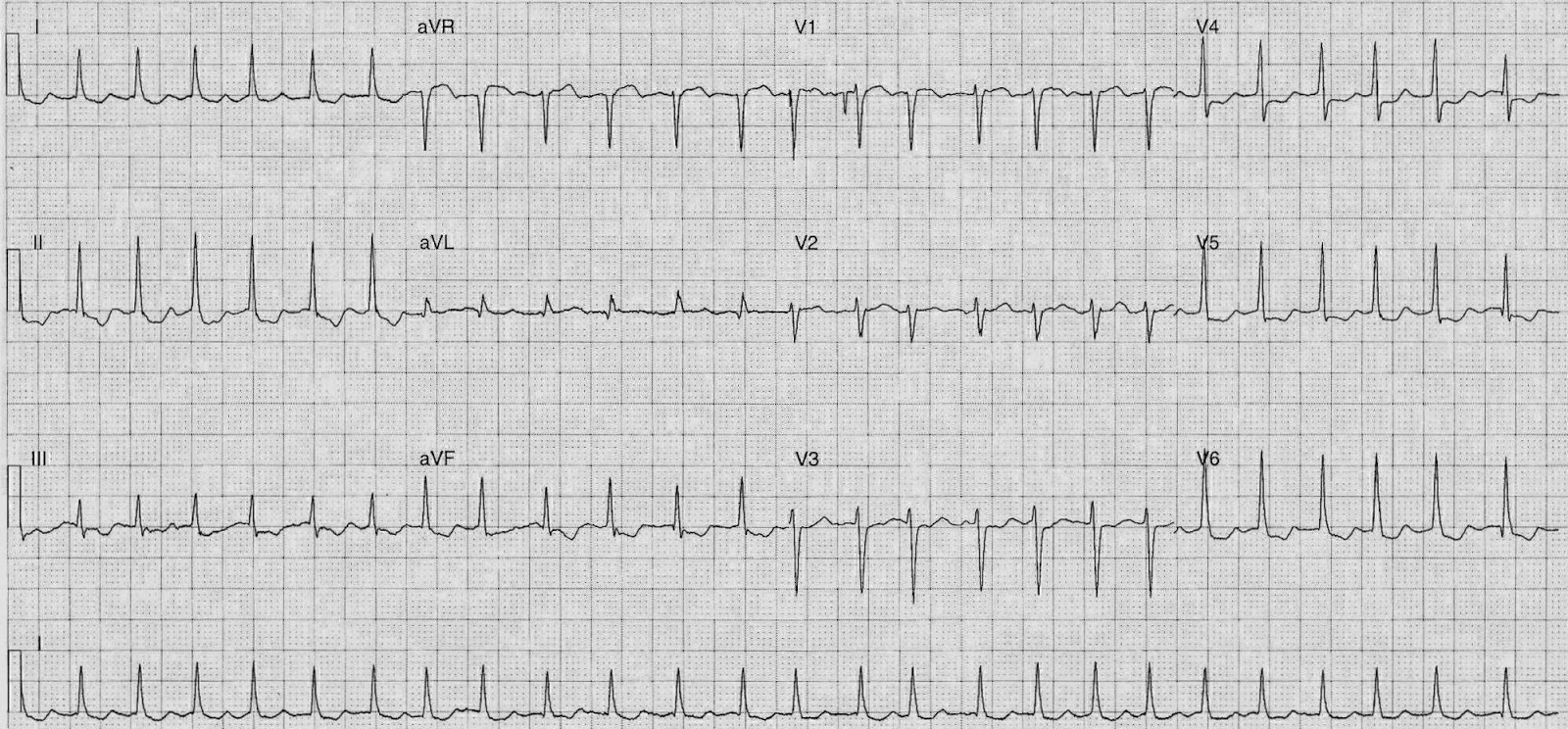 ECG of the Week: ECG of the Week - 29th April 2013 - Interpretation