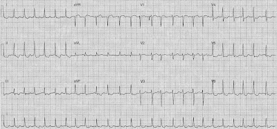 ECG of the Week: ECG of the Week - 29th April 2013 - Interpretation