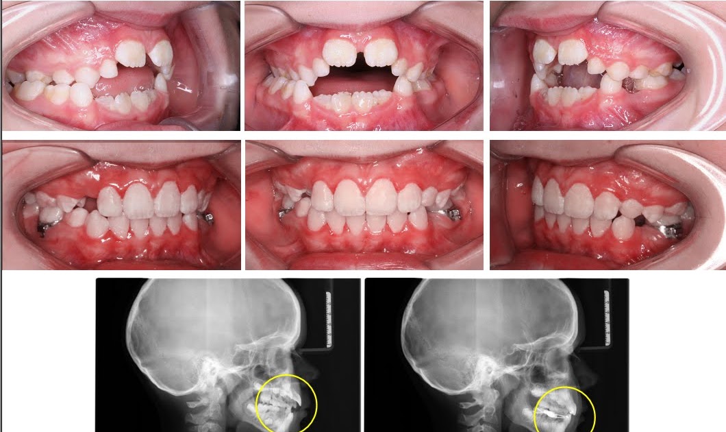 Blogkravitzorthodontics Phase I Correction Of Thumbsucking