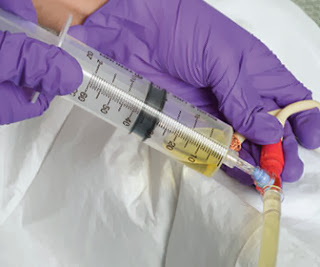 Obtaining a Sterile Urine Specimen From a Catheter ~ Nursing
