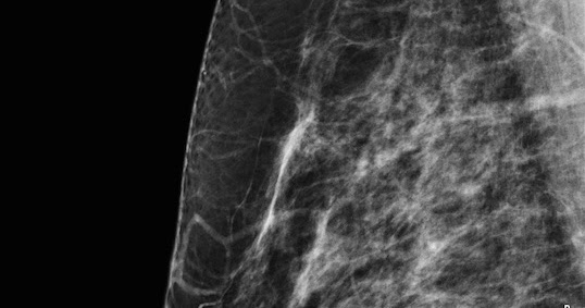 Mamografías Lleida. Unidad de Diagnóstico de Patología Mamaria: ME SALE ...