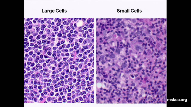 Non-Hodgkin limfom- simptomi, uzroci, lečenje