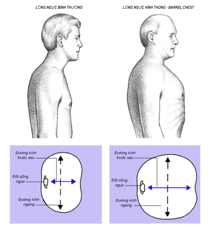 Dấu hiệu lồng ngực hình thùng - Barrel chest