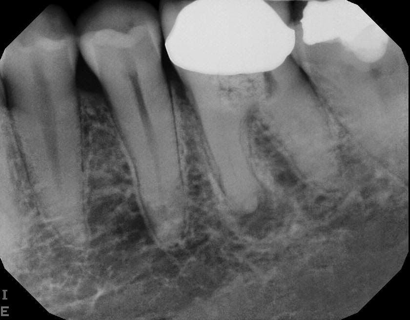 Boyd4Endo: Case 44 Incomplete root canal under crown
