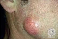 Tipps Gesundheit: Talgzysten Behandlung Tipps