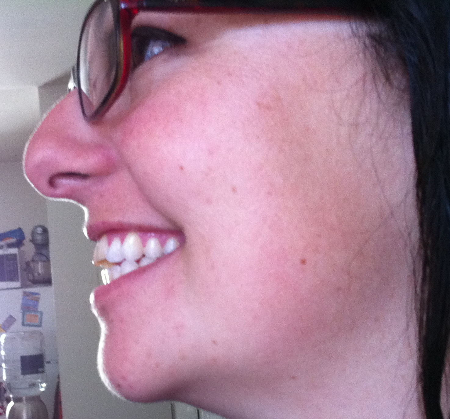 Braceface: The Sequel (a jaw surgery and braces blog): REALLY Open Bite