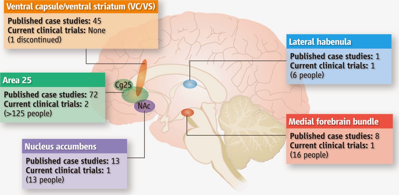 The Neurocritic: Update on the BROADEN Trial of DBS for Treatment ...