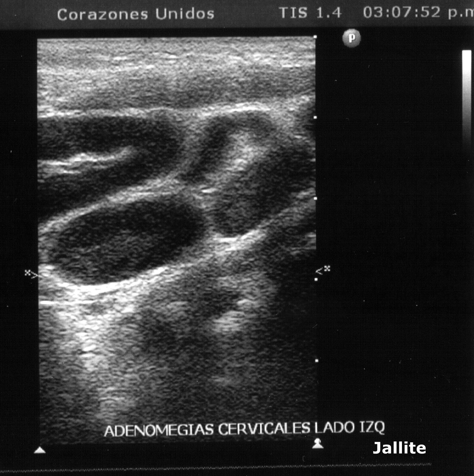 Mononucleosis Infecciosa