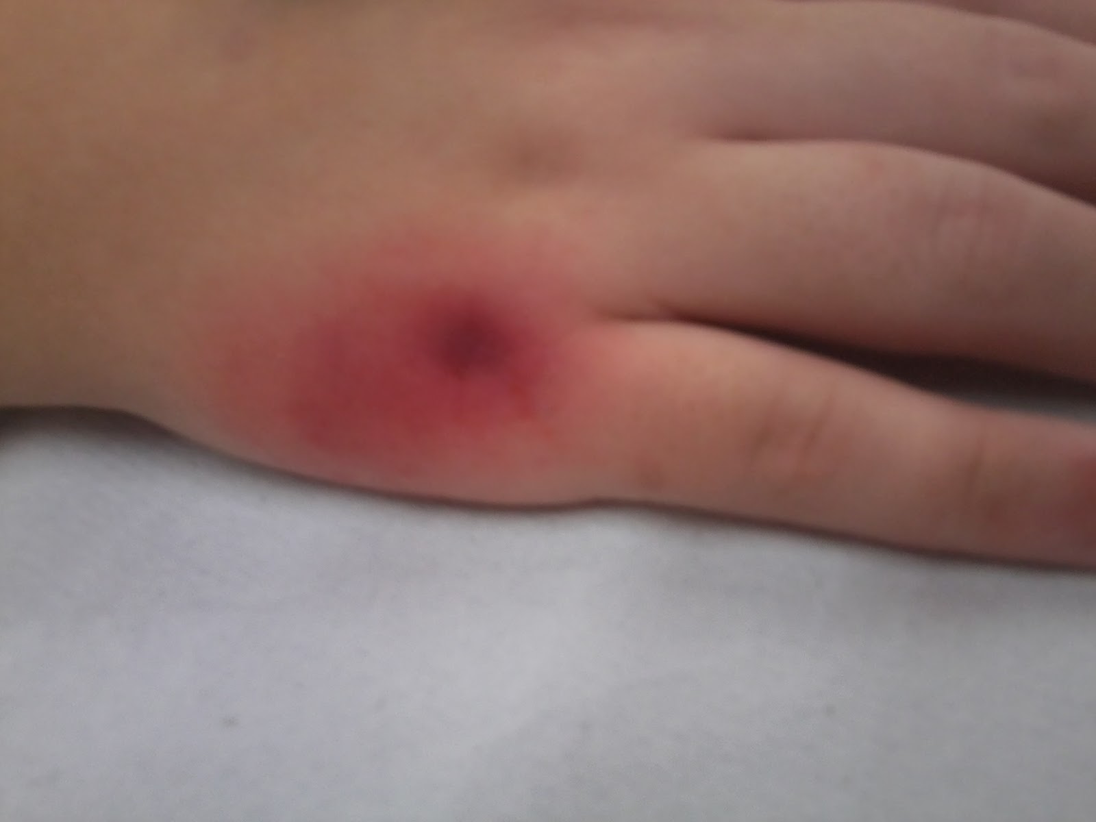 Andrea caracterización: CORTES, QUEMADURAS Y MORATONES