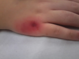 Andrea caracterización: CORTES, QUEMADURAS Y MORATONES