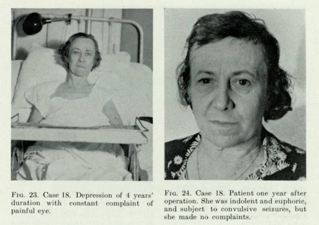 Do You Need a Lobotomy? Just Look at the Results From These Before and ...