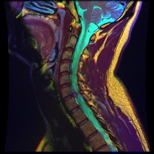 Nevit's blog: Color MRI of Cervical vertebrae